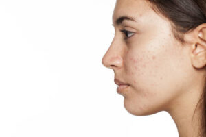 15 Makeup Artist–Approved Ways to Cover Zits