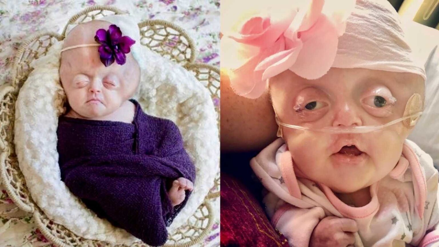 My Baby Was Born With Pfeiffer Syndrome