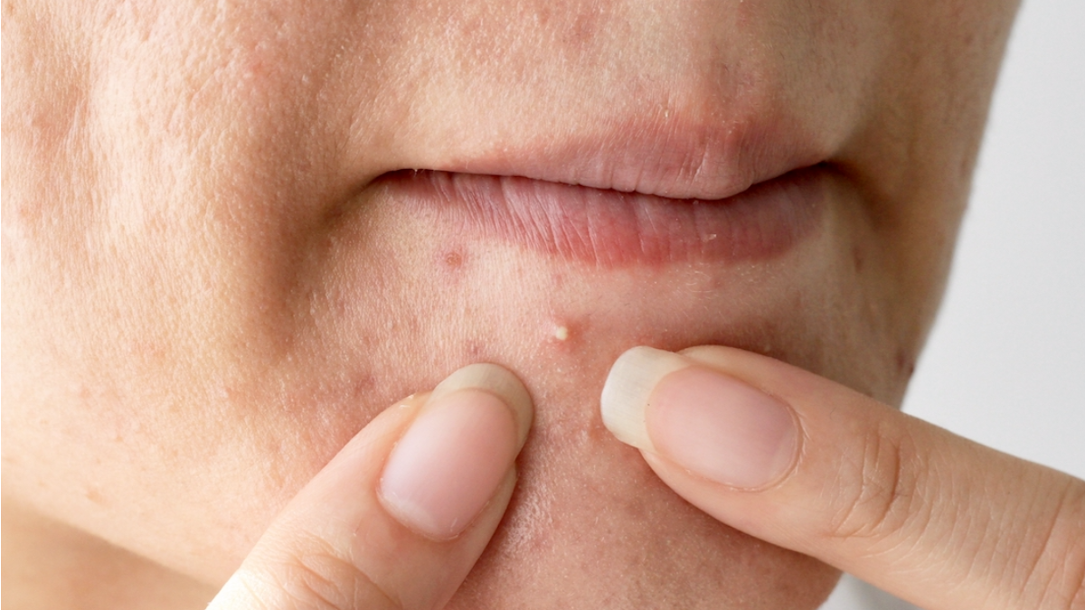 6 ways you're popping your pimples all wrong