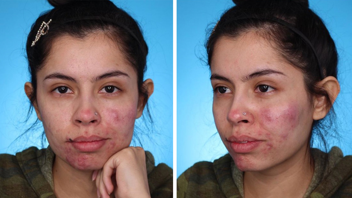 Makeup Artist Was Ashamed Of Acne Until She Incorporated It Into Her ...