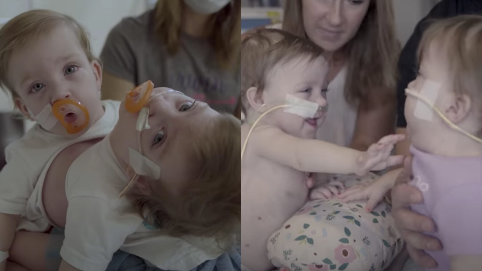 Conjoined Identical Twins Born 'Wrapped in an Embrace' Are Successfully ...