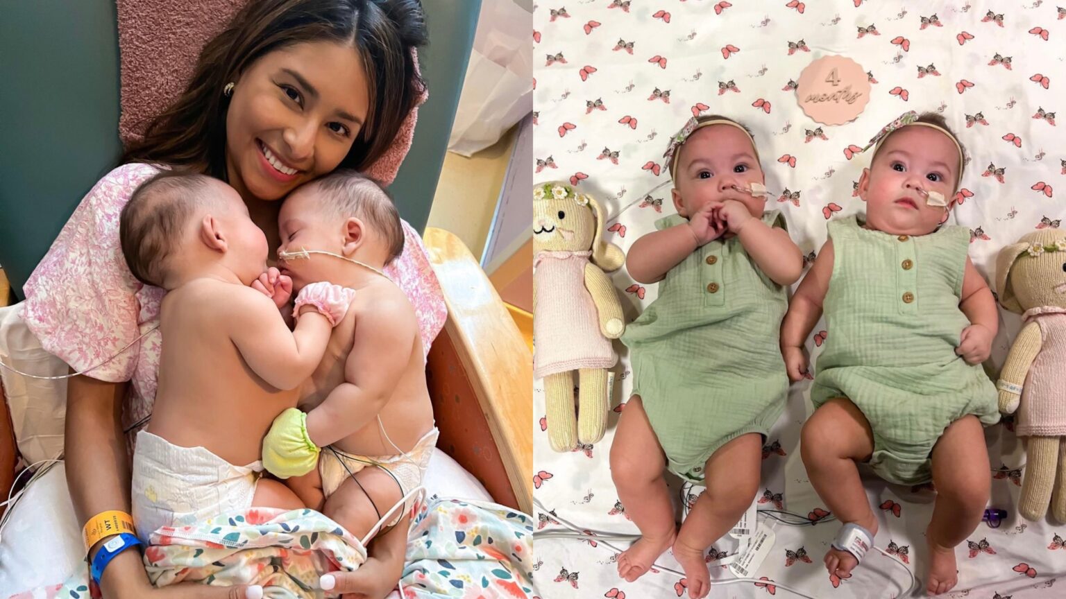 Formerly Conjoined Twins Home From Hospital After Successful Separation ...