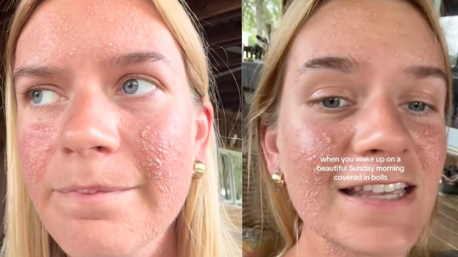 Woman Discovers Her Mysterious Rash Was Caused By Spider