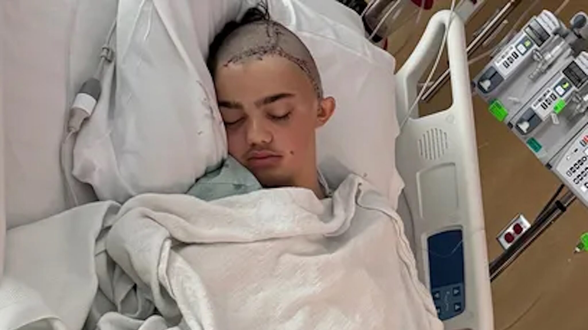 14-Year-Old Attacked by Classmate Needs 60 Staples in Skull